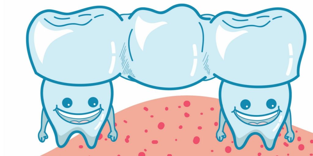 Ways To Prevent The 4 Most Common Dental Bridge Problems - Keep 28 Dental