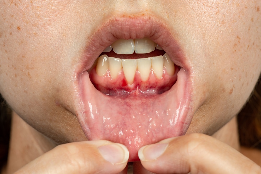 Effective Ways To Get Rid Of A Gum Infection