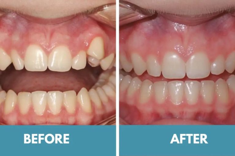 Invisalign Before and After: Things You Should Know